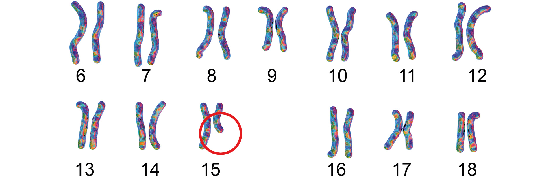 Sindrome de Prader-Willi