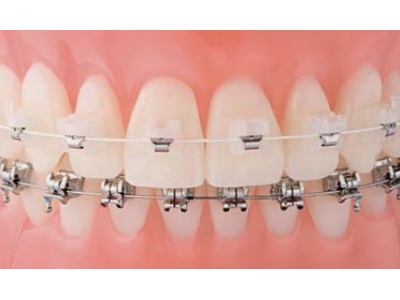 6 tipos de brackets