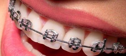 Brackets metálicos